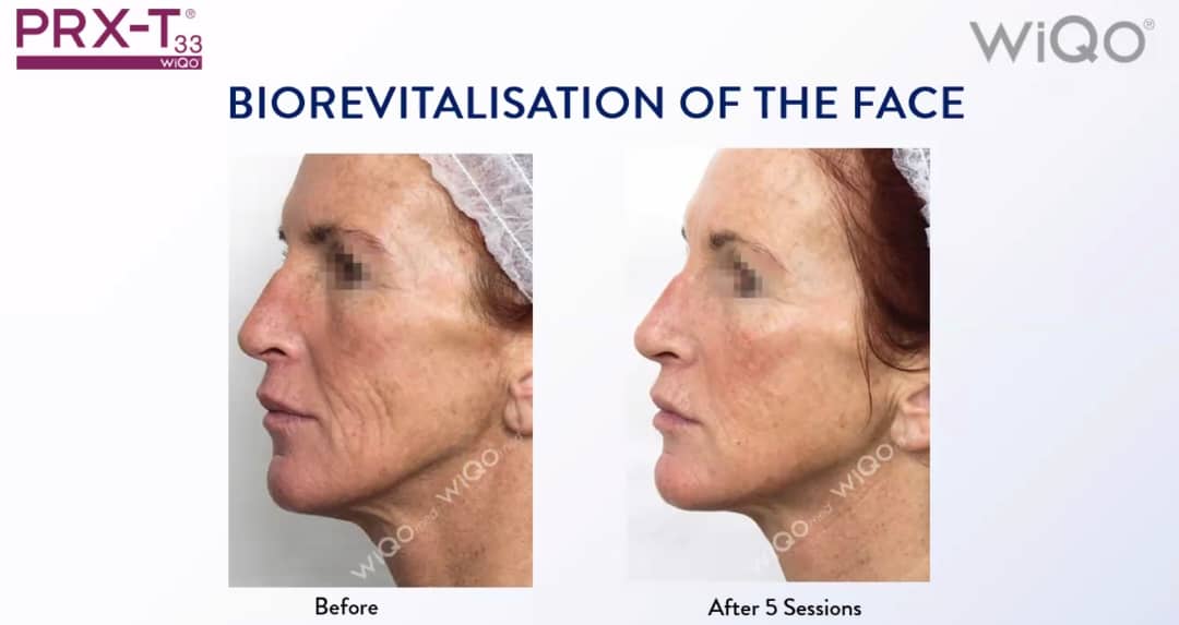 PRX T-33 Peel – Dr Audrey & Dr R Clinic