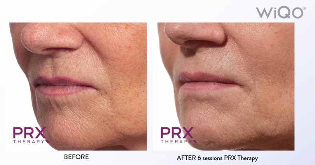 PRX T-33 Peel - Dr Audrey & Dr R Clinic